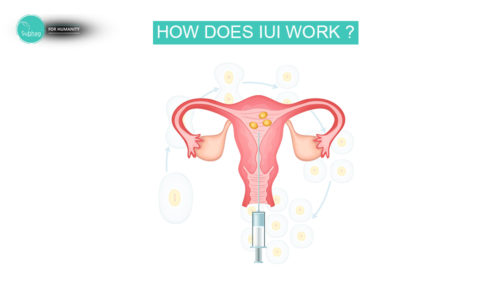 Step by Step Guidance of IUI Procedure for Infertility Treatment